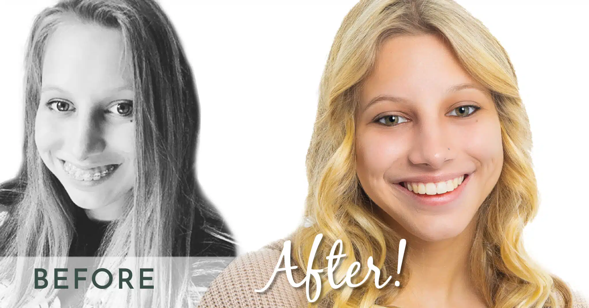 Before and After Braces Face Shape — Shoe Orthodontics Hanover, PA ... Before and After Braces Face Shape — Shoe Orthodontics Hanover, PA ...