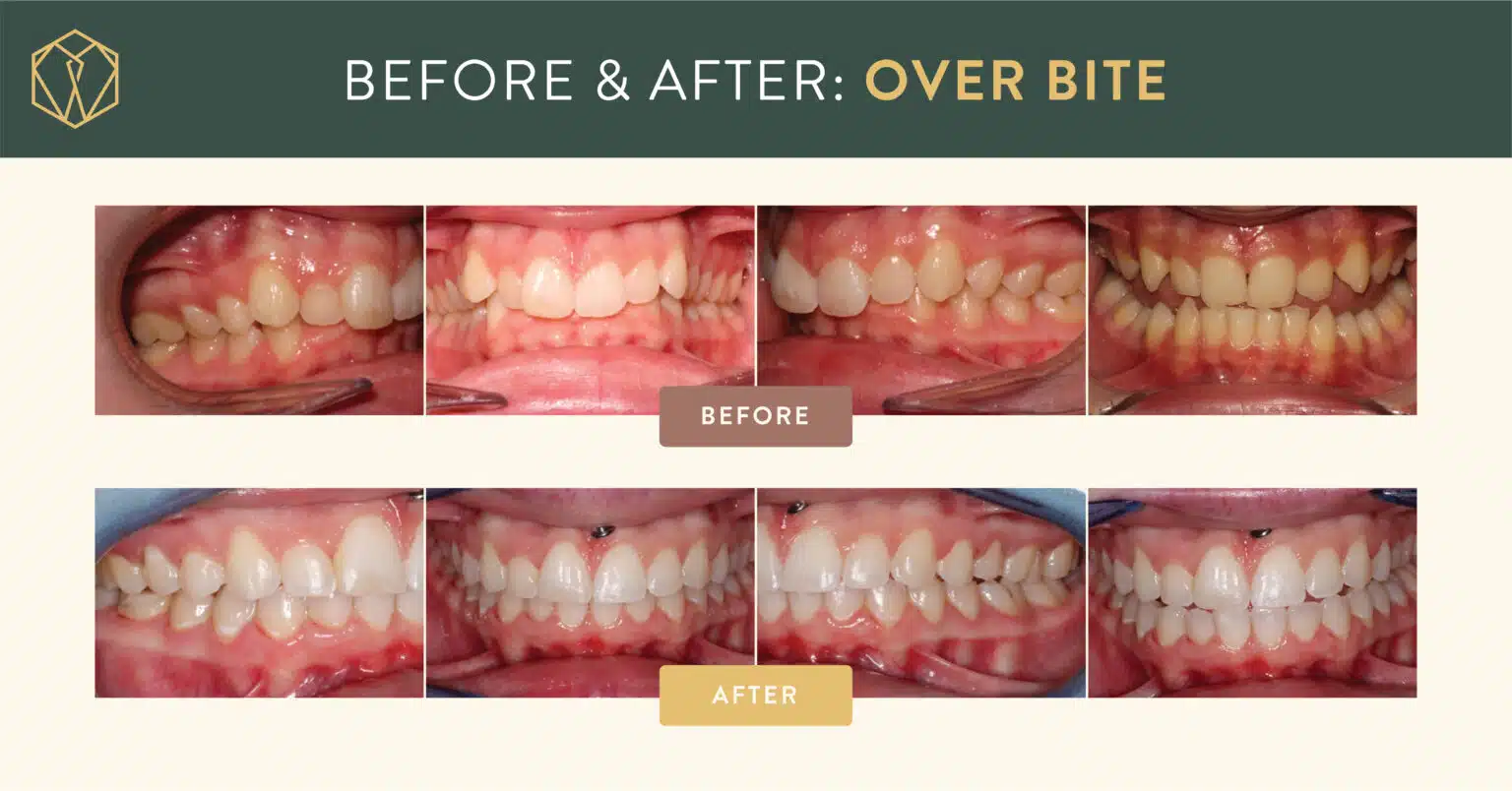 What Can Braces Fix? 9 Ways They Can Improve Your Smile — Shoe ...
