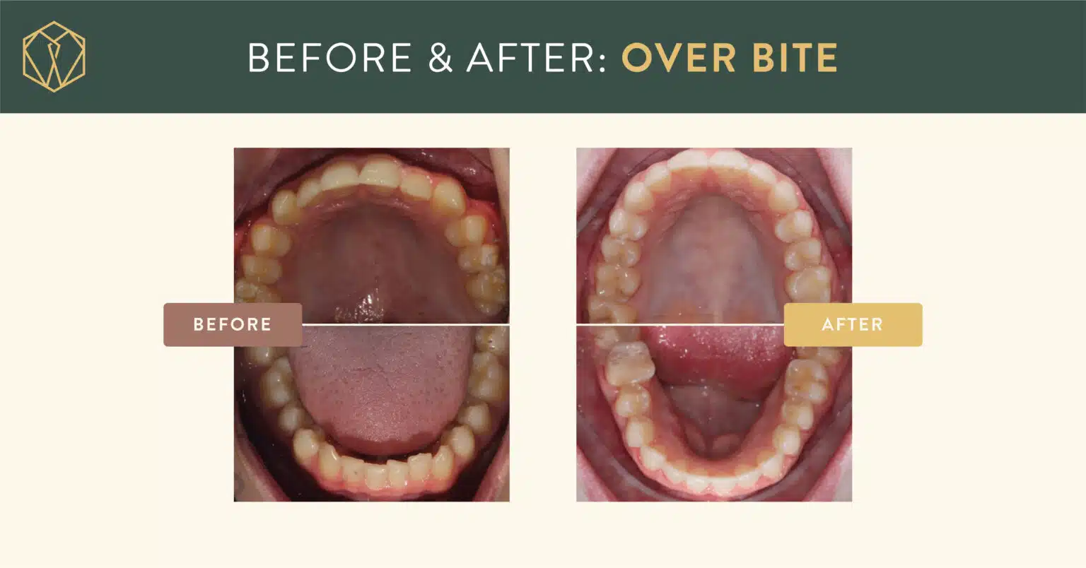 What Can Braces Fix? 9 Ways They Can Improve Your Smile — Shoe ...